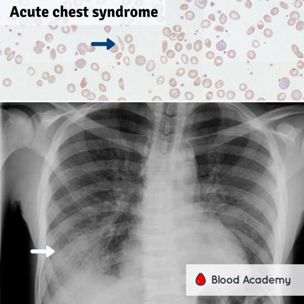 Acute Chest Syndrome (ACS) - Blood Academy