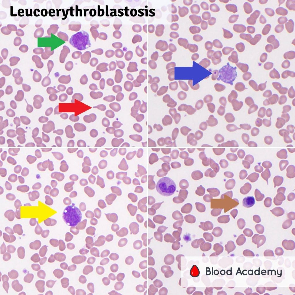 Leucoerythroblastosis - Blood Academy