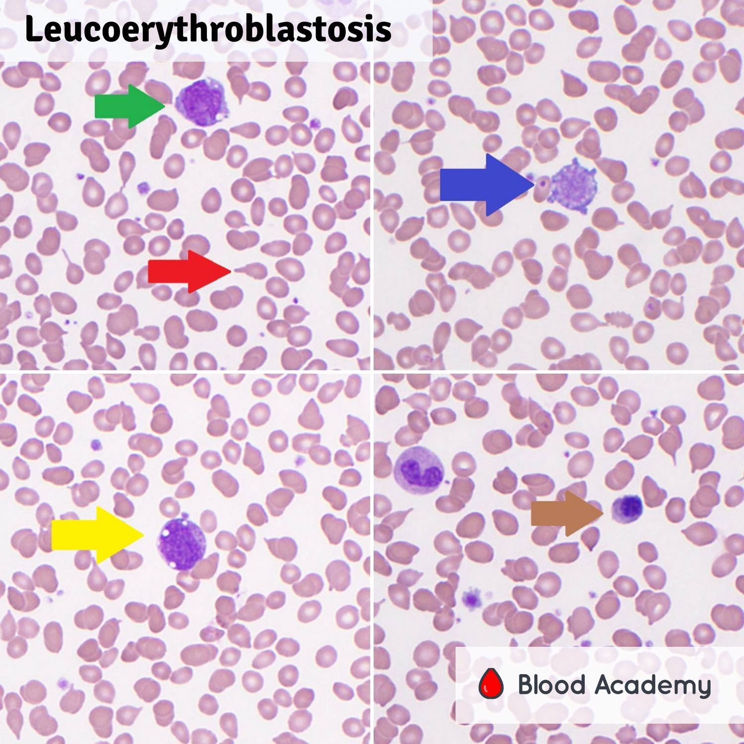 Leucoerythroblastosis - Blood Academy