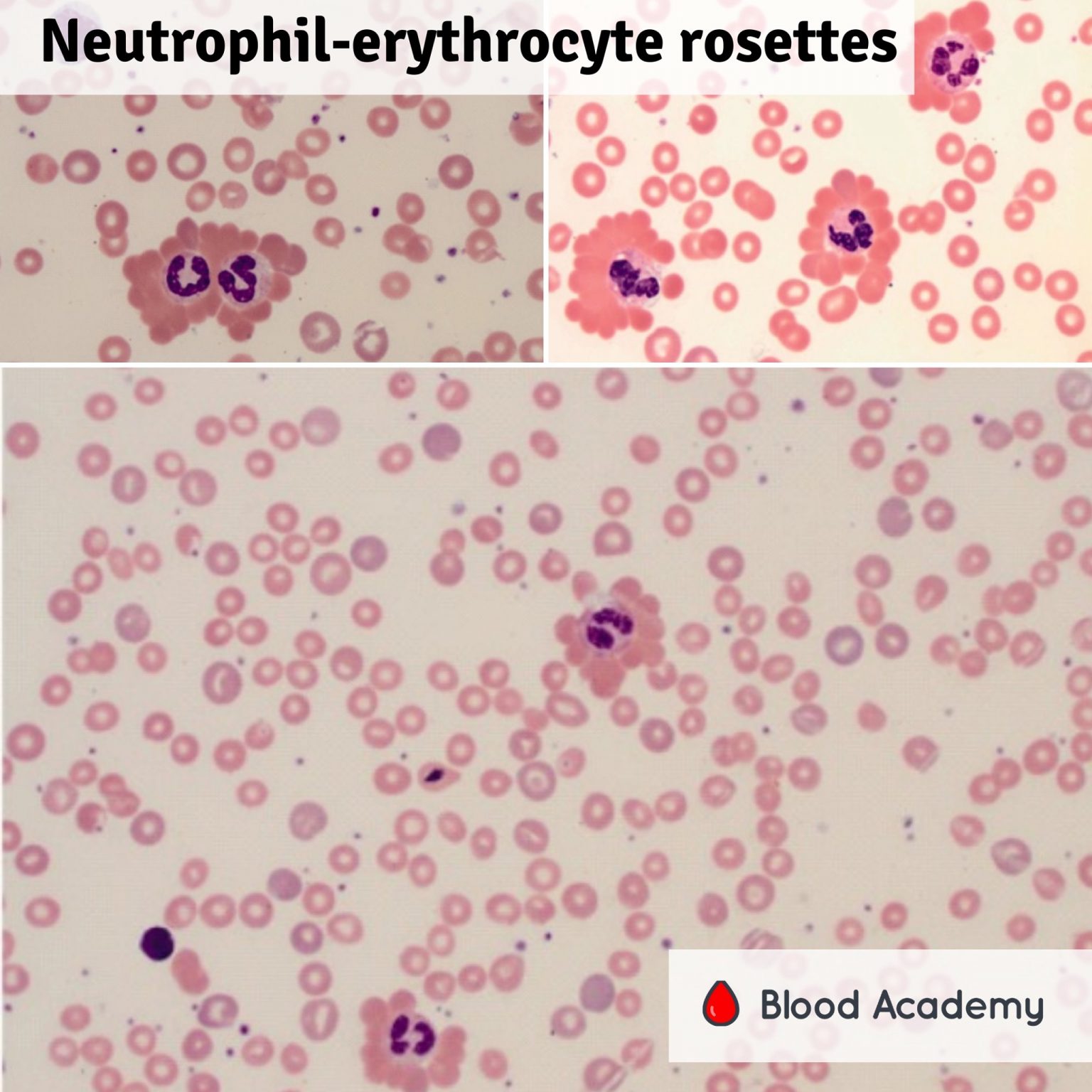 Leukocyte erythrocyte rosettes - Blood Academy