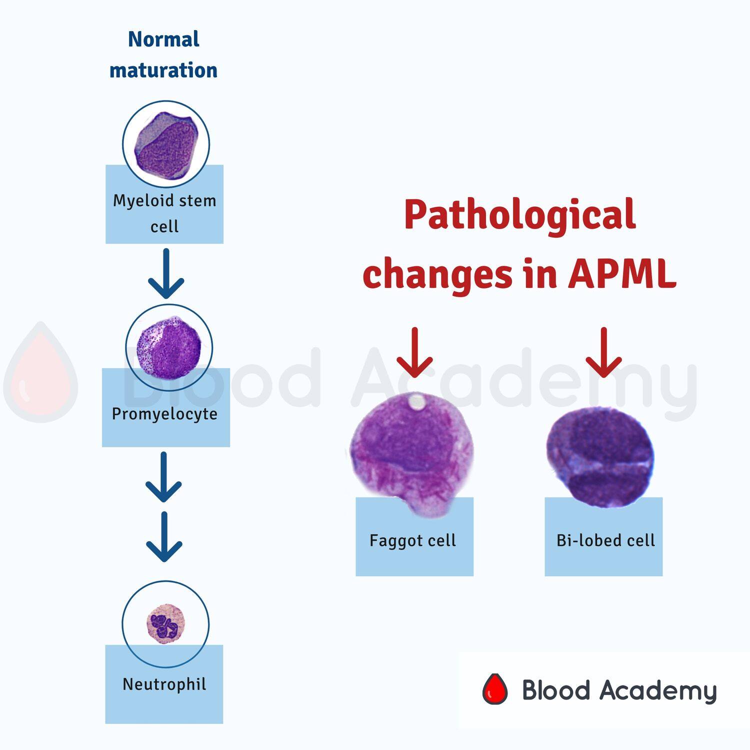 Acute Promyelocytic Leukaemia - Blood Academy